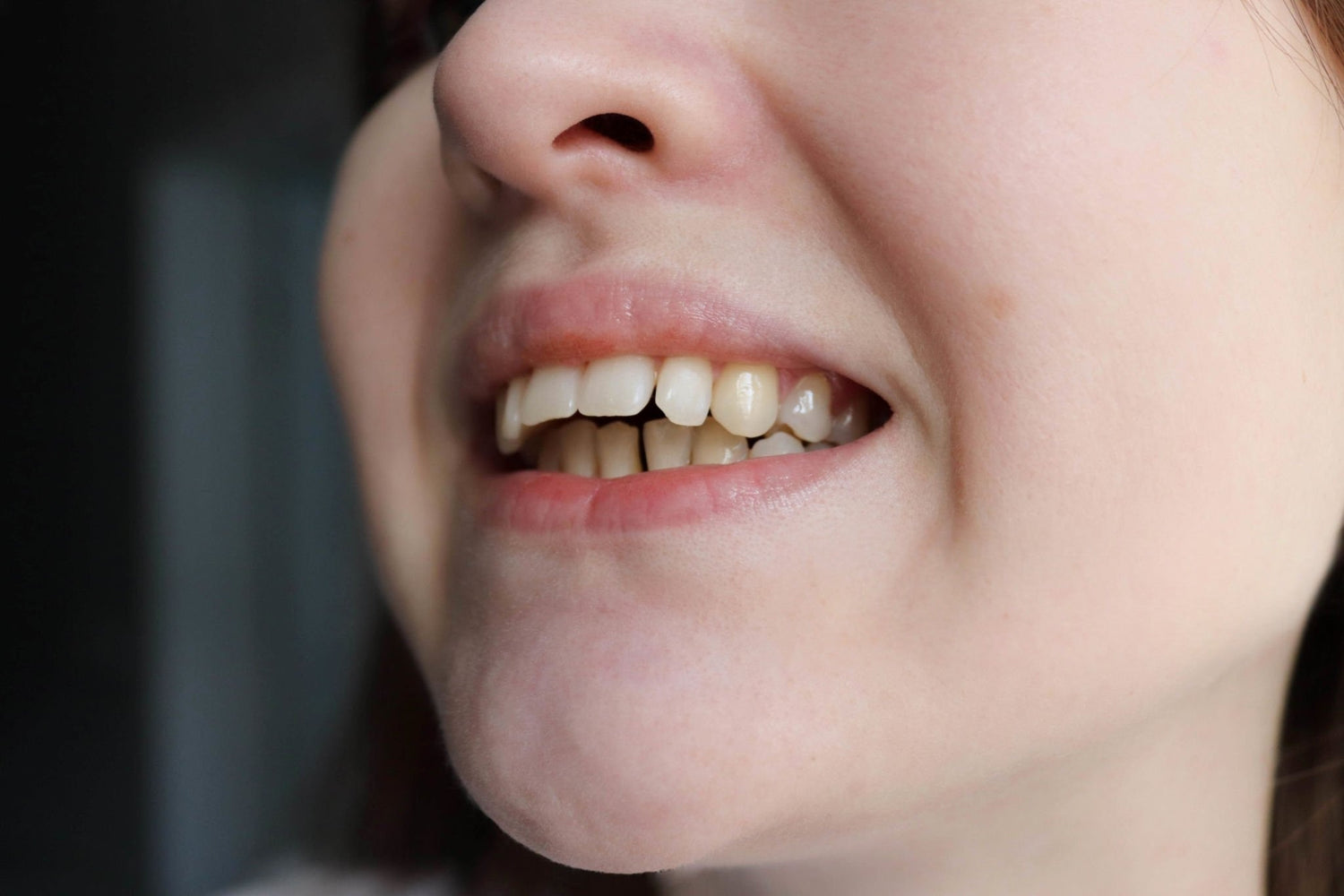 what is overbite, its causes, effects & how to fix it With Clear ...